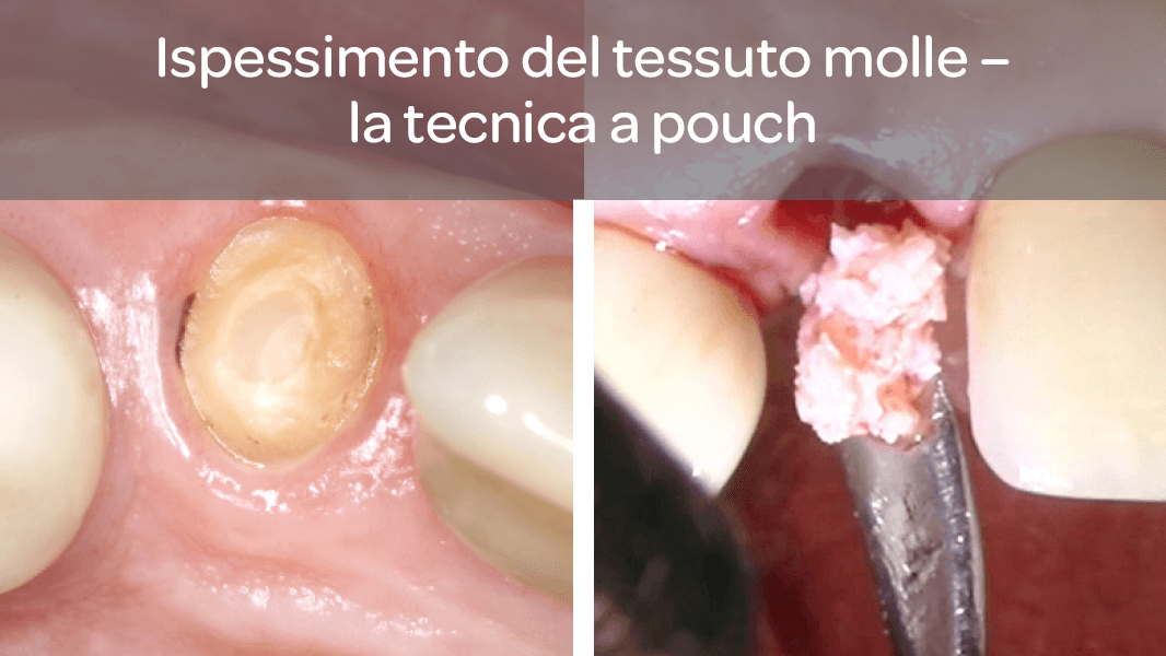 NovoMatrix Soft tissue regeneration